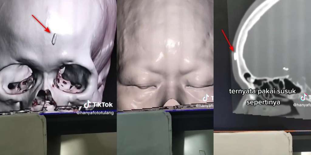 Temukan Benda Asing Mirip Jarum di Dahi Saat Lakukan CT Scan, Ibu-ibu ...